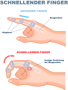 Schnellender Finger | Dr. Markus Paulhart